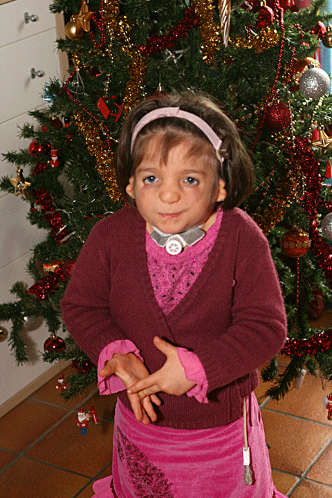 Syndrome de Franceschetti : le portrait de Sofia